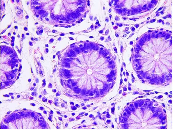 Nieuwe classificatie van darmkanker in de maak - Medisquare